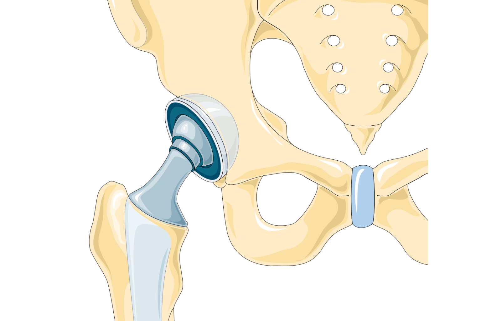 Hip Replacement Thailand – Total Hip Replacement Surgery in Bangkok ...
